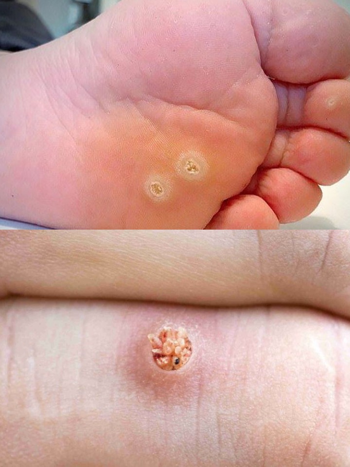 BE VERY CAREFUL: THIS COMMON SKIN GROWTH COULD SIGNAL A SERIOUS HEALTH ...