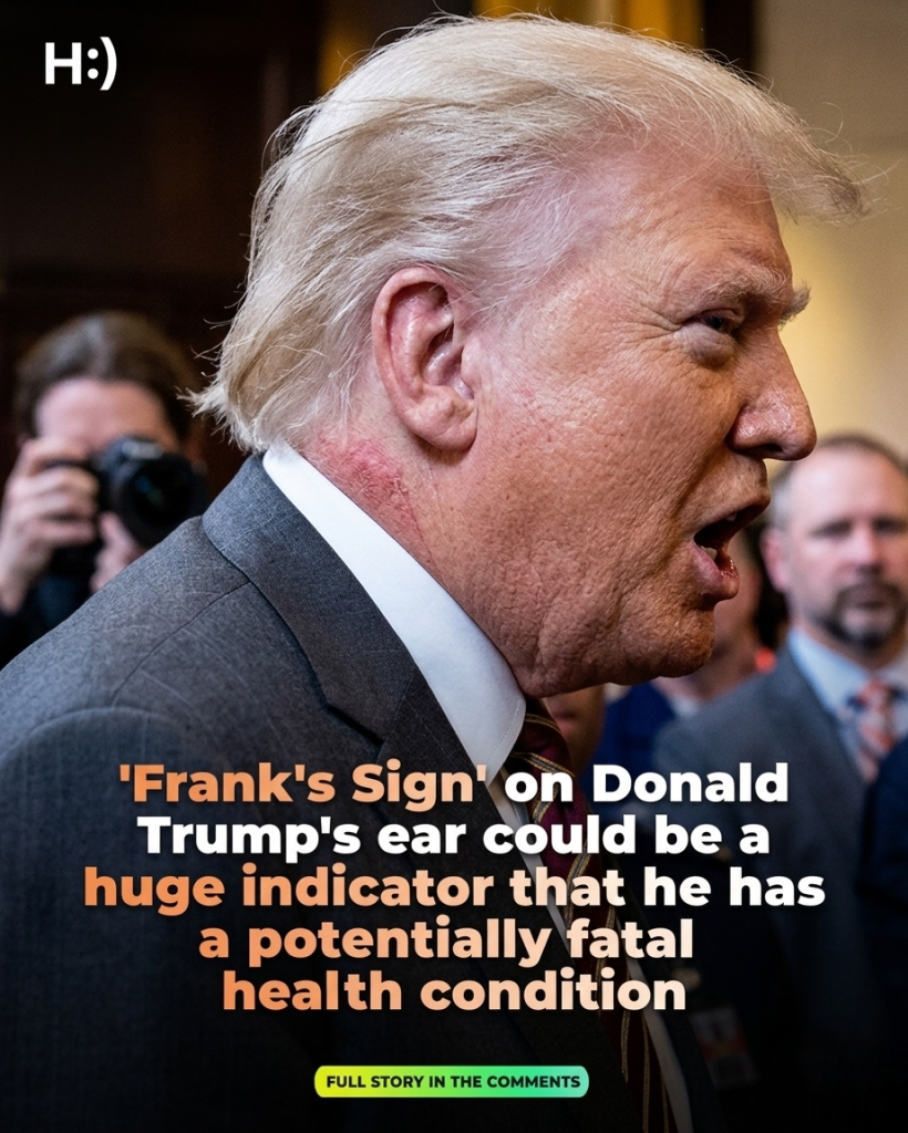 Doctors say “Frank’s Sign,” a diagonal crease on the earlobe, may ...